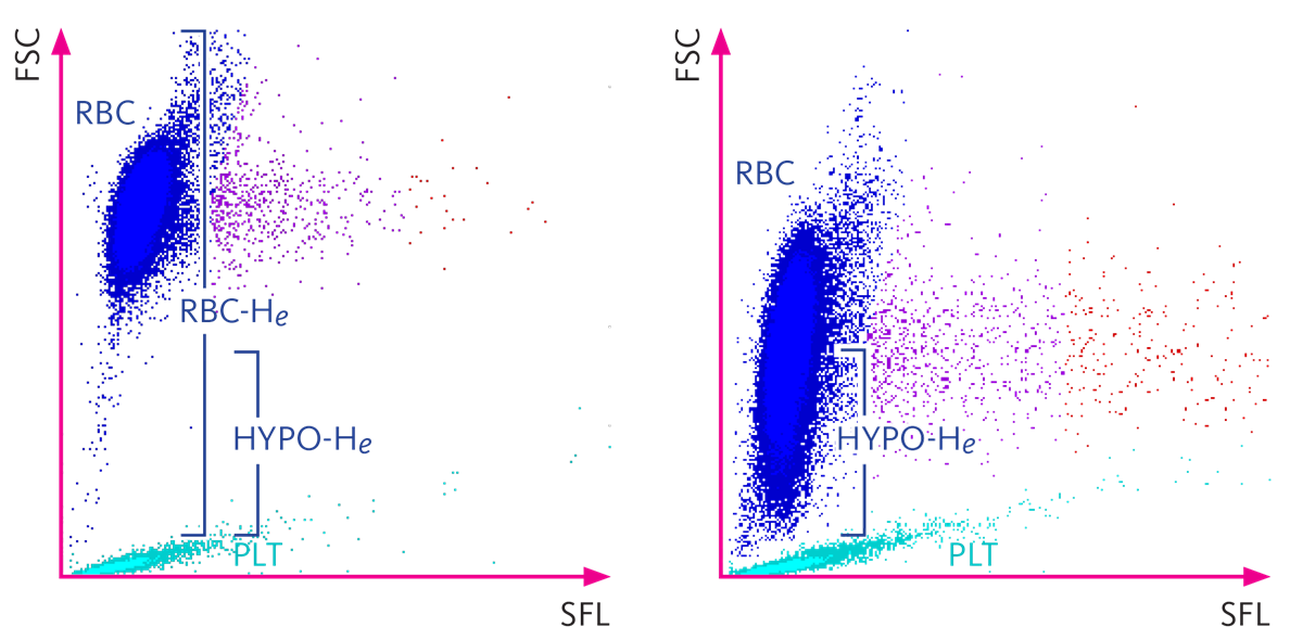 New CBC Parameters in Anemia Diagnostics :: Erba Mannheim